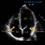 Focused Cardiac Ultrasound for the Nephrologist: The apical window ...