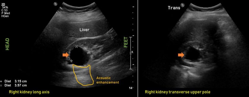 Ultrasound features of Kidney Cysts - Renal Fellow Network