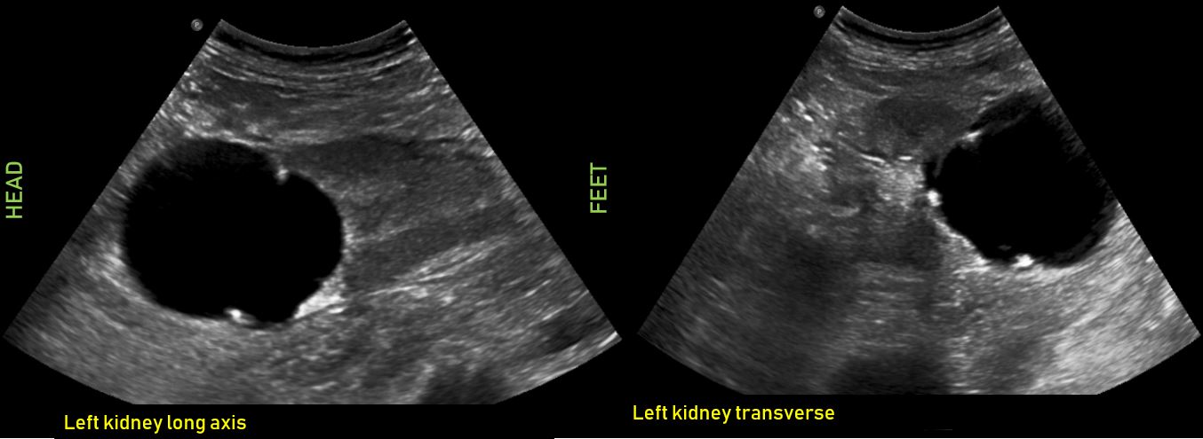 Ultrasound features of Kidney Cysts - Renal Fellow Network