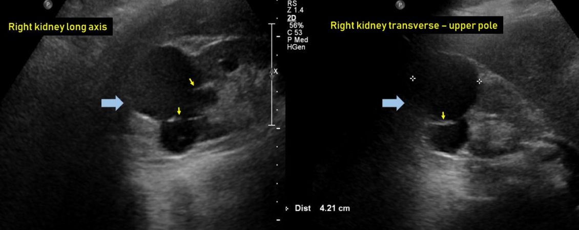 Ultrasound features of Kidney Cysts - Renal Fellow Network