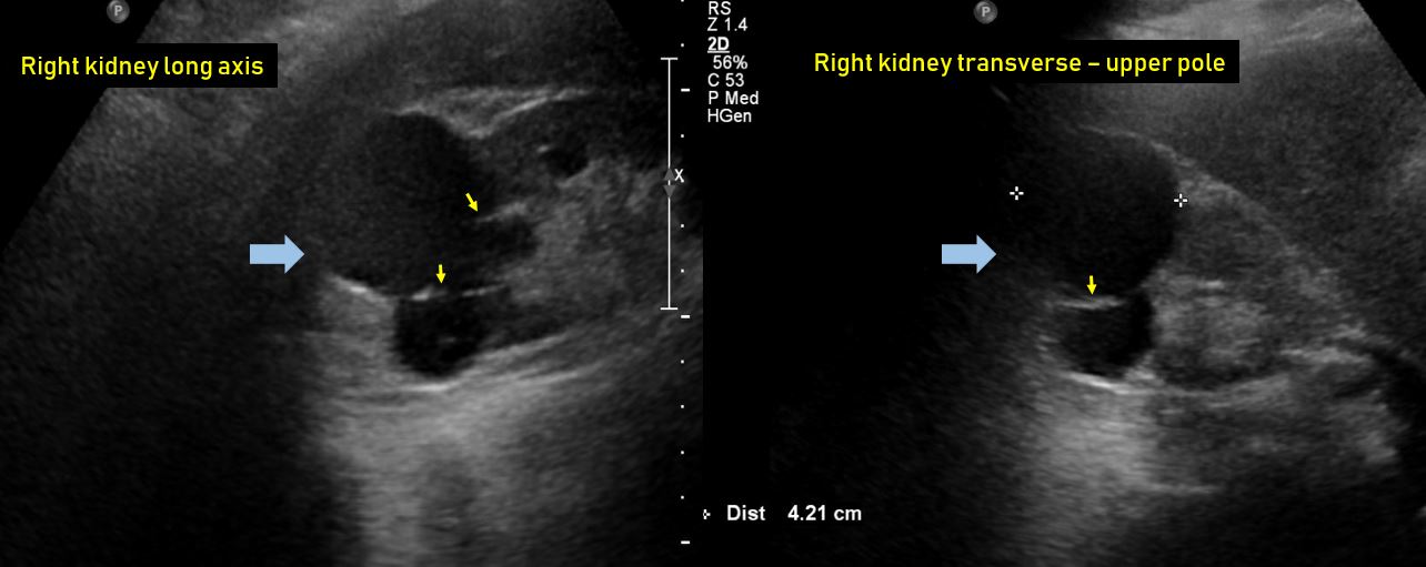 Ultrasound features of Kidney Cysts - Renal Fellow Network