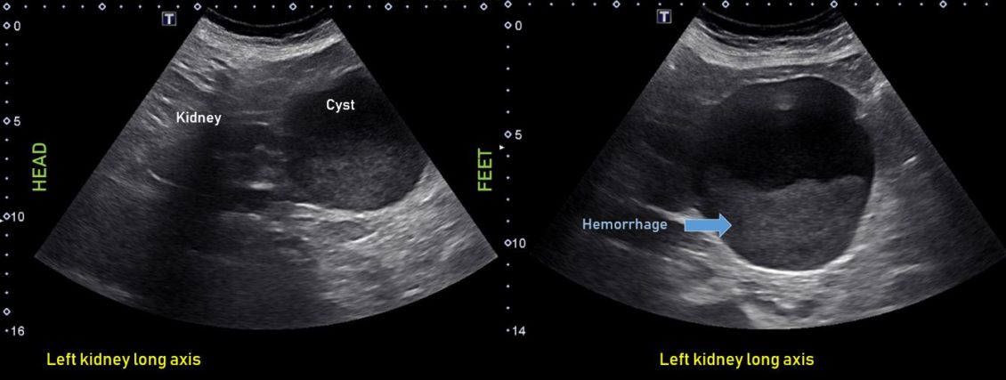 Ultrasound features of Kidney Cysts - Renal Fellow Network