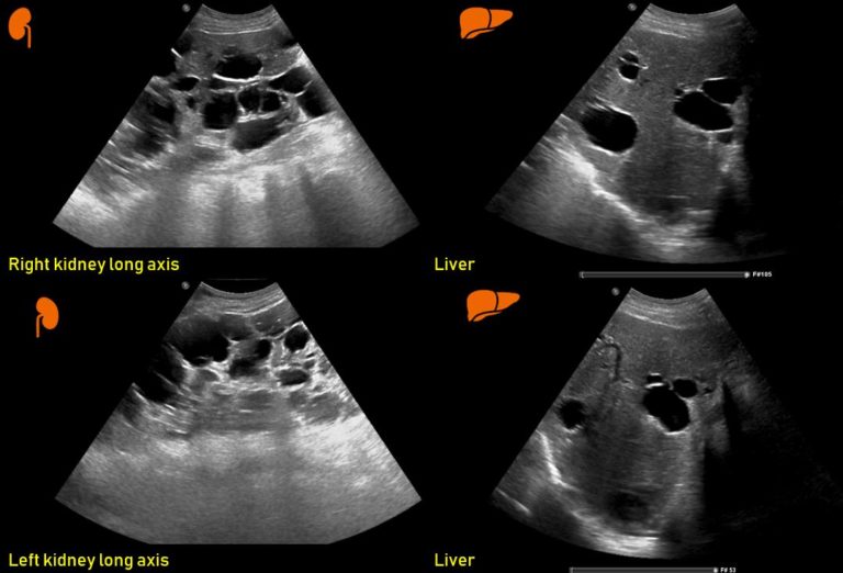 Ultrasound features of Kidney Cysts - Renal Fellow Network