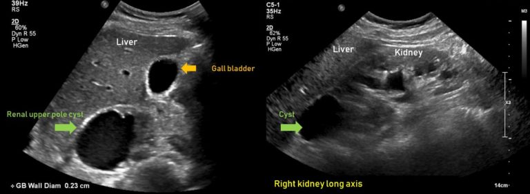 Ultrasound features of Kidney Cysts - Renal Fellow Network