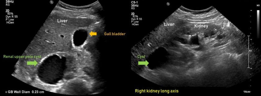 Ultrasound features of Kidney Cysts - Renal Fellow Network