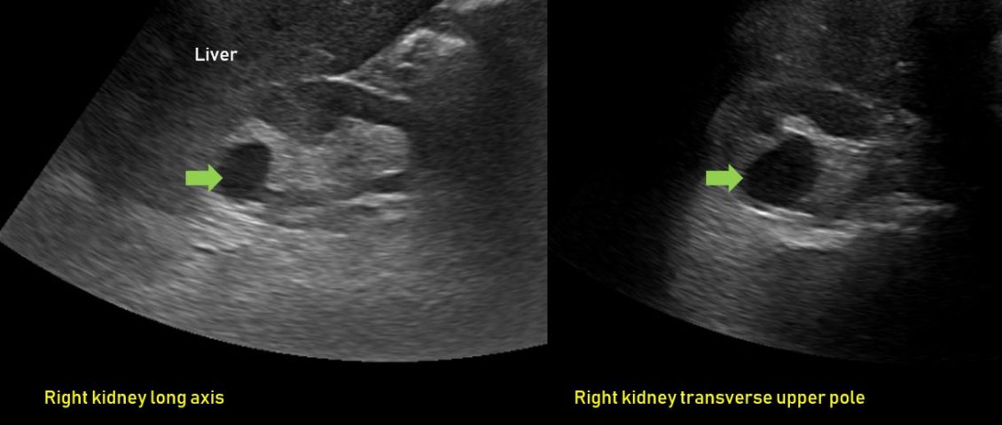 Ultrasound features of Kidney Cysts - Renal Fellow Network