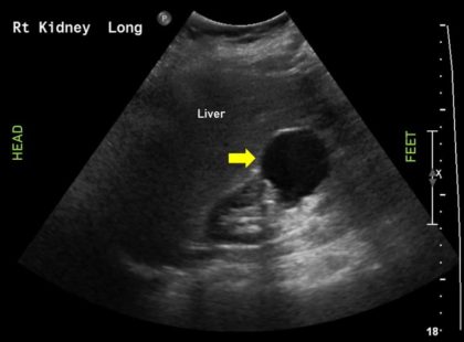 Ultrasound features of Kidney Cysts - Renal Fellow Network