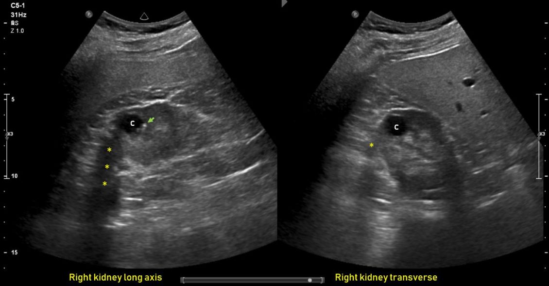 Ultrasound features of Kidney Cysts - Renal Fellow Network