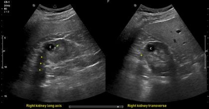 Ultrasound features of Kidney Cysts - Renal Fellow Network