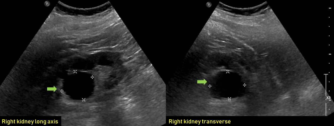 Ultrasound features of Kidney Cysts - Renal Fellow Network