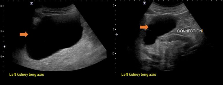 Ultrasound features of Kidney Cysts - Renal Fellow Network