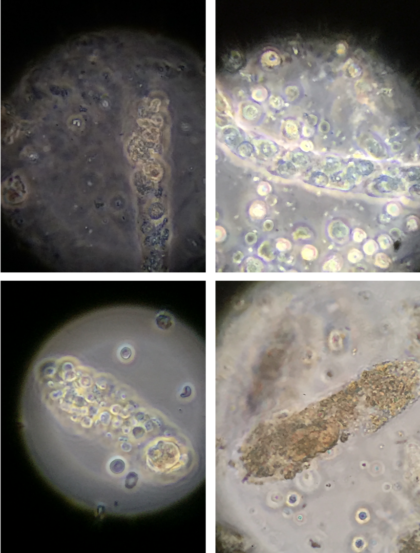 Urine Sediment of the Month: How to Get a High Quality Image - Renal ...