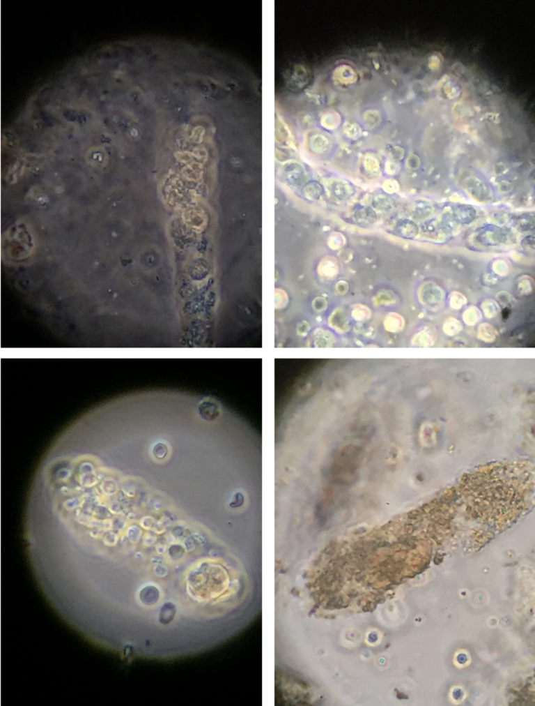 Urine Sediment of the Month: How to Get a High Quality Image - Renal ...