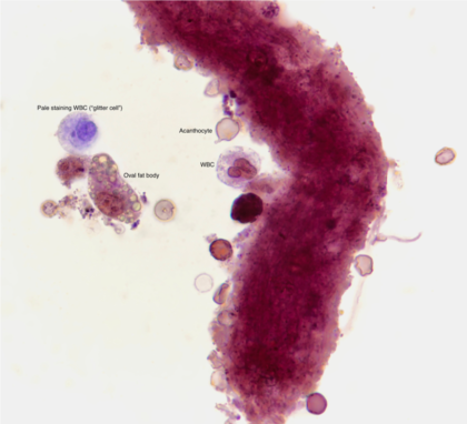 Urine Sediment of the Month: How to Get a High Quality Image - Renal ...