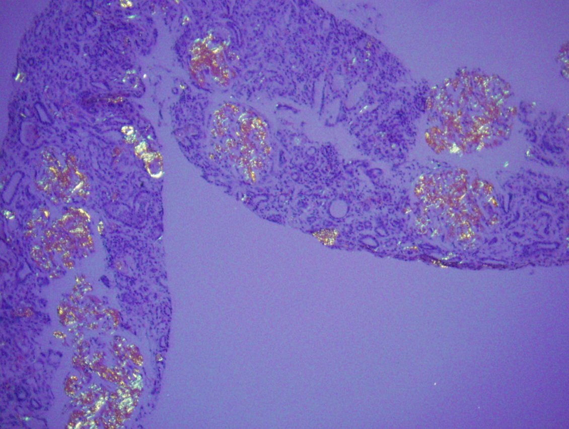 Urine Sediment of the Month: The Visible Sediment - Renal Fellow Network