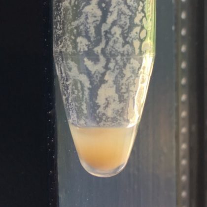 Urine Sediment of the Month: The Visible Sediment - Renal Fellow Network