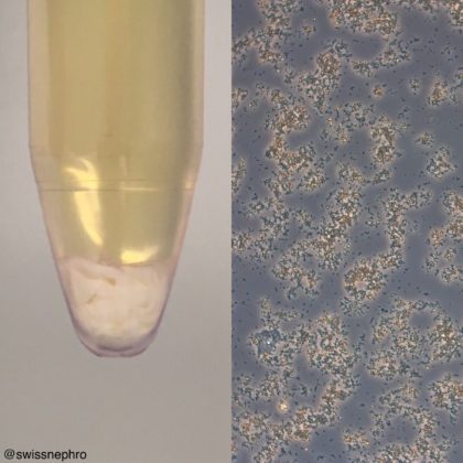 Urine Sediment of the Month: The Visible Sediment - Renal Fellow Network