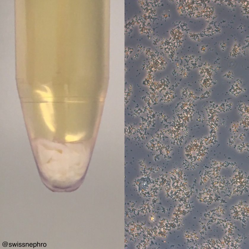 Urine Sediment of the Month: The Visible Sediment - Renal Fellow Network