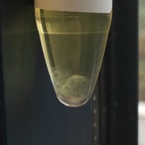 Urine Sediment of the Month: The Visible Sediment - Renal Fellow Network