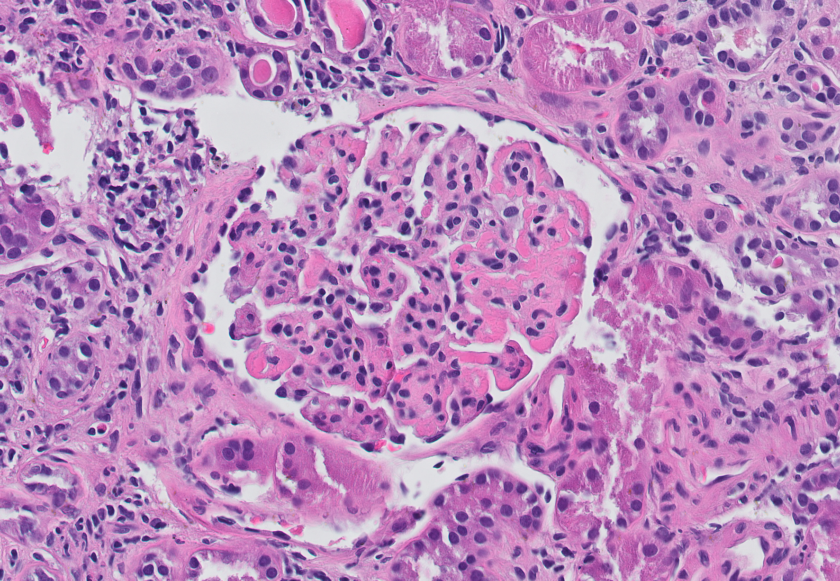 Kidney Biopsy of the Month: Glomerular diseases with organized deposits ...