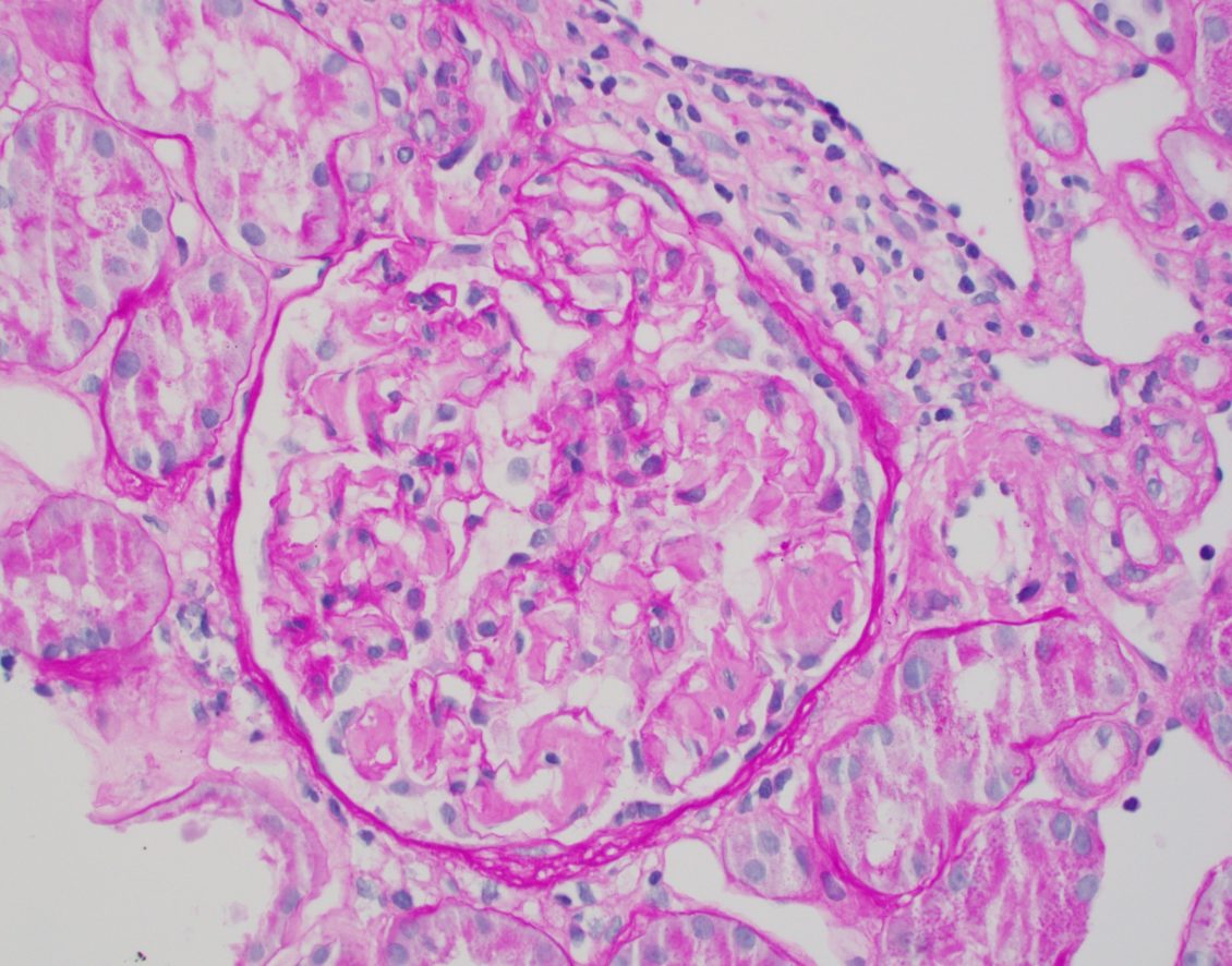 Kidney Biopsy of the Month: Glomerular diseases with organized deposits ...