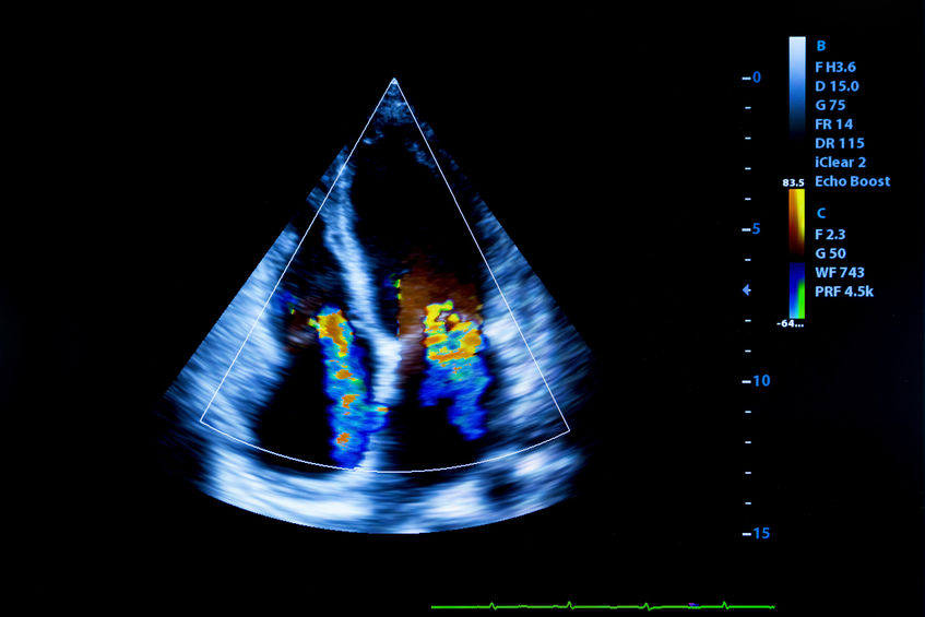 Focused Cardiac Ultrasound: Abnormalities on the Apical View - Renal ...