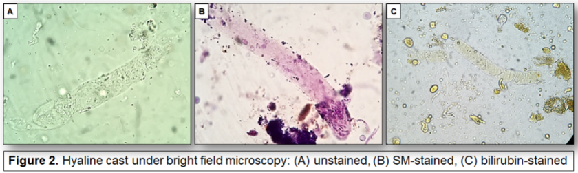 Urine Sediment of the Month: Colorless, Transparent Hyaline Casts ...