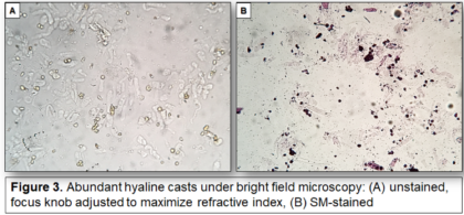 Urine Sediment of the Month: Colorless, Transparent Hyaline Casts ...