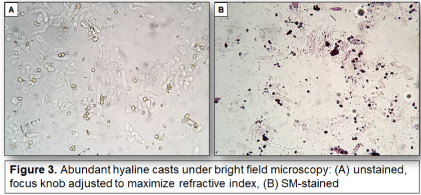 Urine Sediment of the Month: Colorless, Transparent Hyaline Casts ...