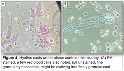 Hyaline Cast Urine