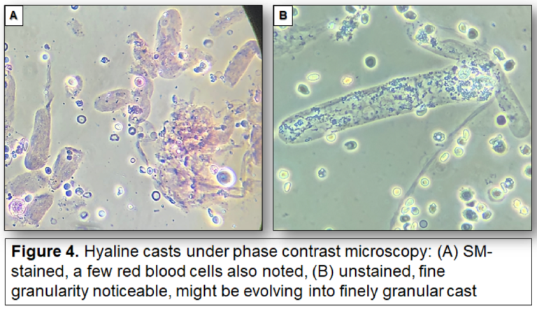 Prognosis and Management of Primary FSGS: The GlomCon Series - Renal ...