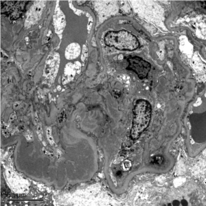 Urine Sediment of the Month: Pigmented Casts & What Those Pretty Colors ...