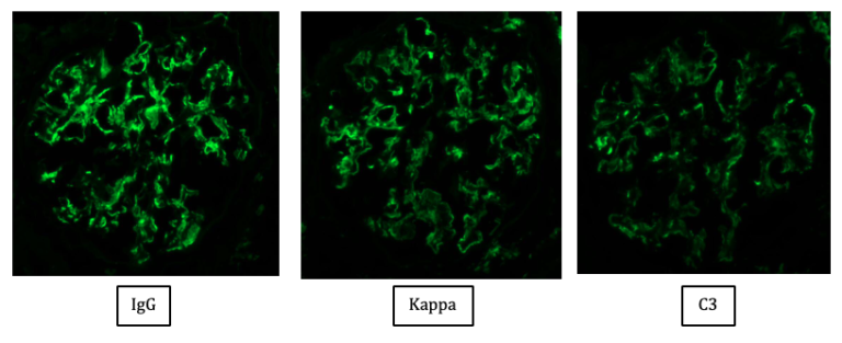 Kidney Biopsy of the Month: Proliferative Glomerulonephritis with ...