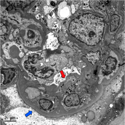 Kidney Biopsy of the Month: Proliferative Glomerulonephritis with ...