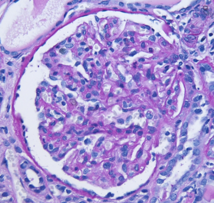 Kidney Biopsy of the Month: C3 Glomerulonephritis - Renal Fellow Network