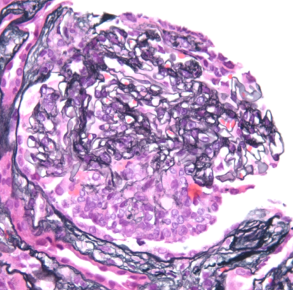 Kidney Biopsy of the Month: C3 Glomerulonephritis - Renal Fellow Network