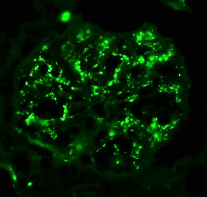 Kidney Biopsy of the Month: C3 Glomerulonephritis - Renal Fellow Network