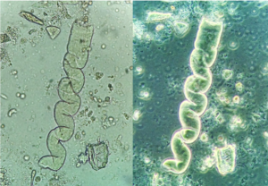 Urine Sediment of the Month: Pigmented Casts & What Those Pretty Colors ...
