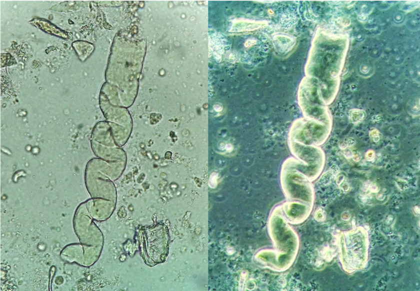 Urine Sediment of the Month: Pigmented Casts & What Those Pretty Colors ...