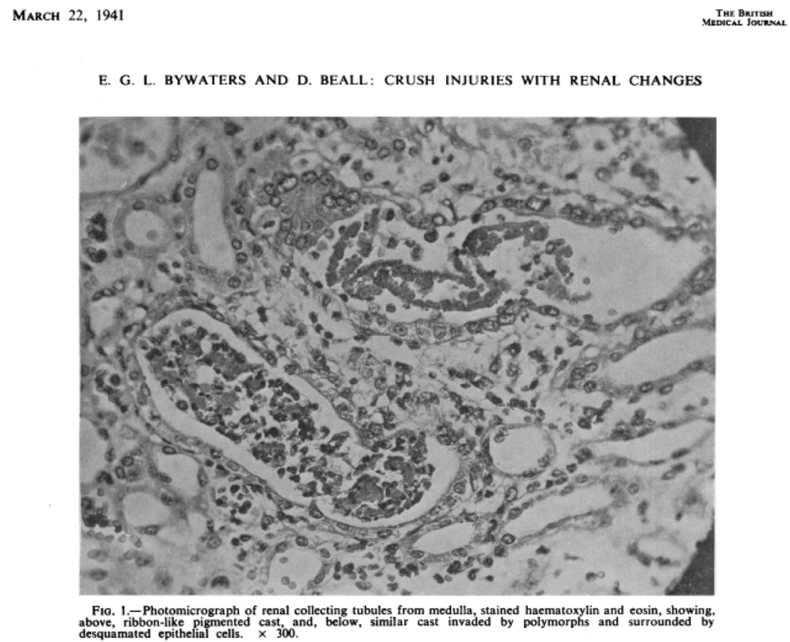 Urine Sediment of the Month: Pigmented Casts & What Those Pretty Colors ...