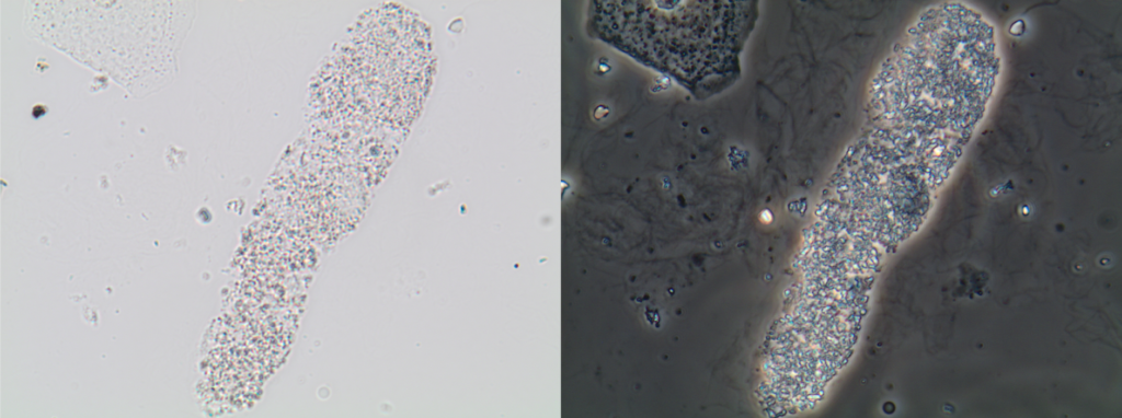 Urine Sediment of the Month: Pigmented Casts & What Those Pretty Colors ...