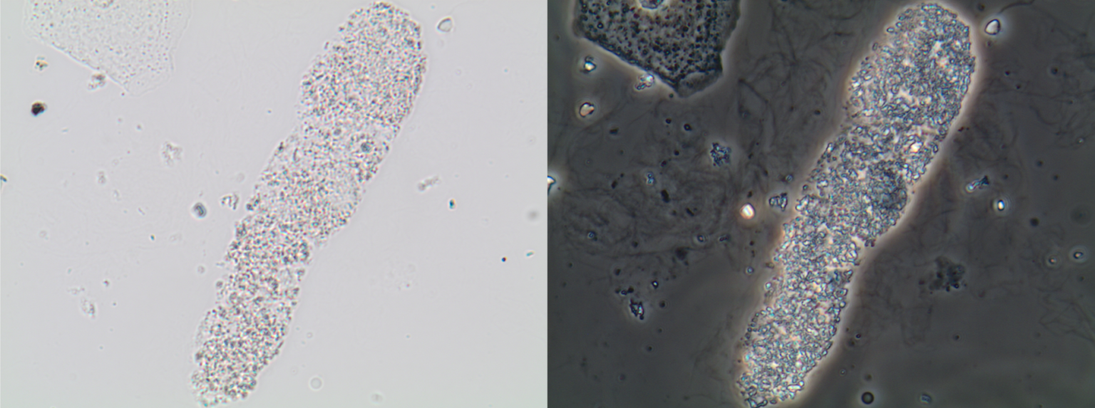 Urine Sediment of the Month: Pigmented Casts & What Those Pretty Colors ...