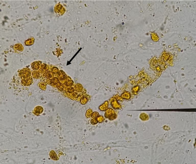 Urine Sediment of the Month: Pigmented Casts & What Those Pretty Colors ...