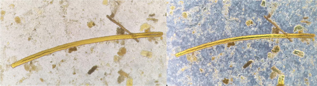 Urine Sediment of the Month: Pigmented Casts & What Those Pretty Colors ...