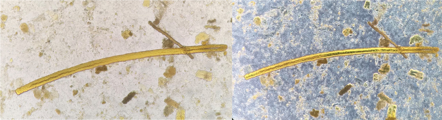 Urine Sediment of the Month: Pigmented Casts & What Those Pretty Colors ...