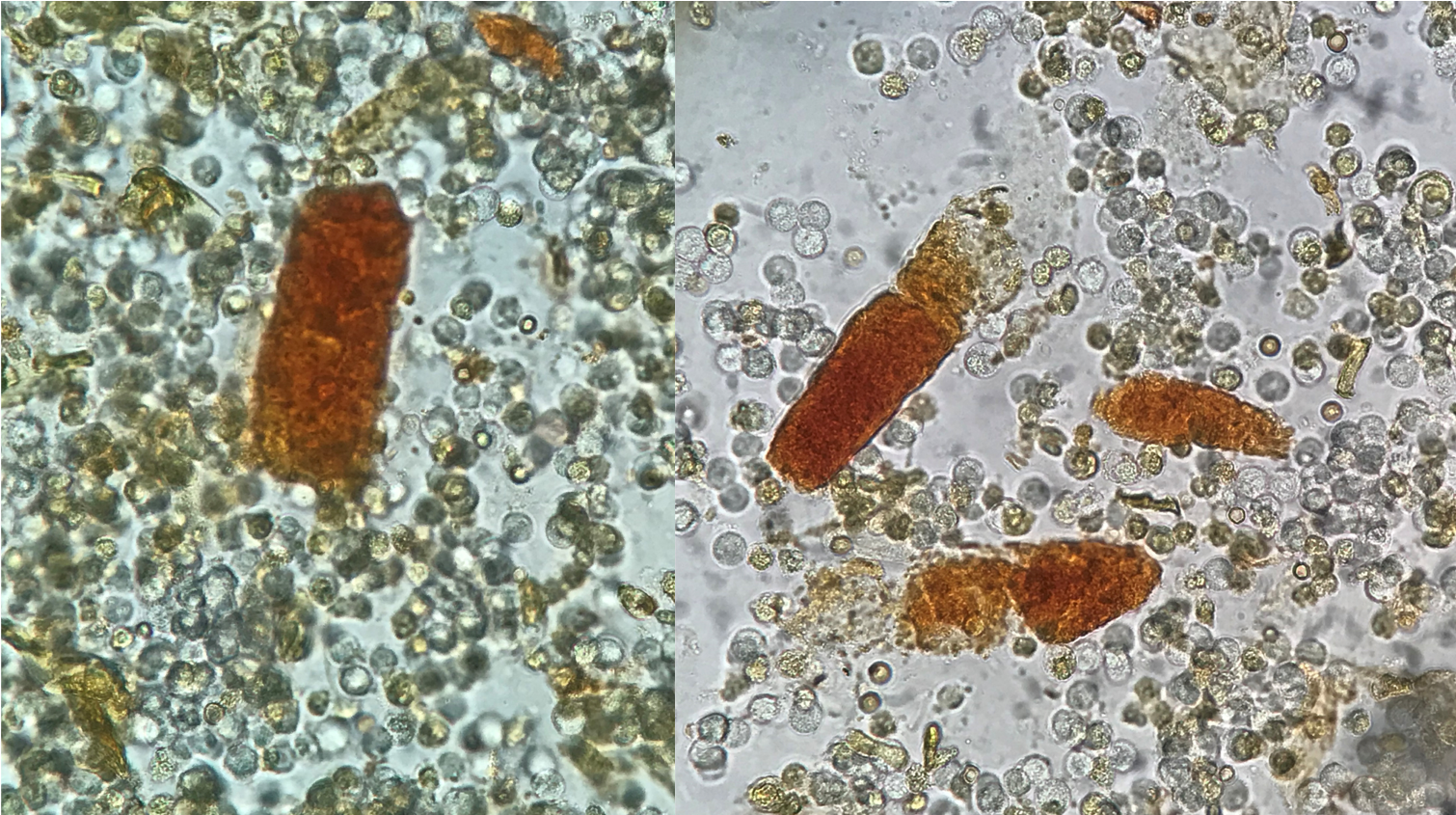 Urine Sediment of the Month: Pigmented Casts & What Those Pretty Colors ...