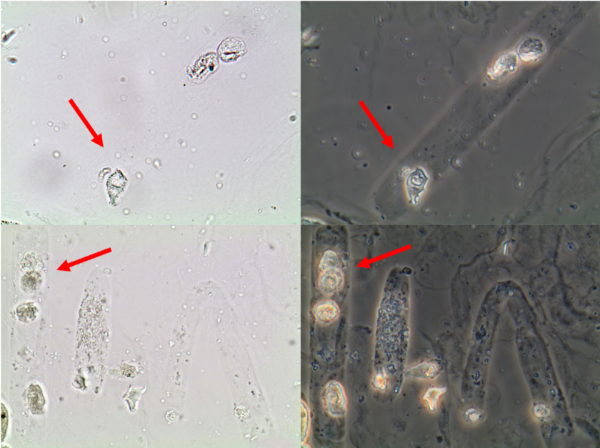Urine Sediment of the Month: Pigmented Casts & What Those Pretty Colors ...
