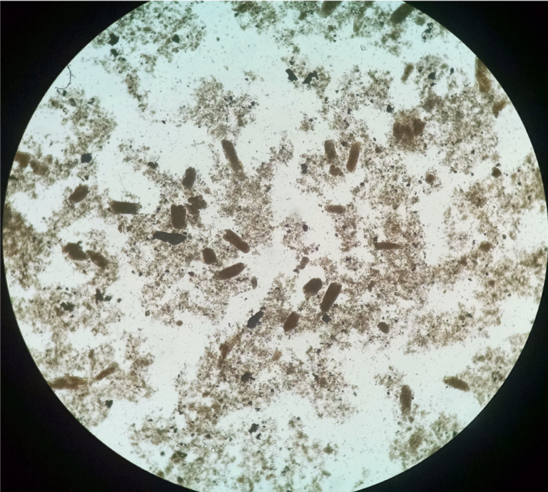 Urine Sediment of the Month: Pigmented Casts & What Those Pretty Colors ...