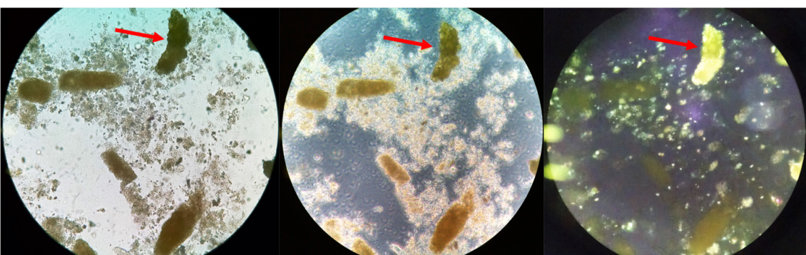 Urine Sediment of the Month: Pigmented Casts & What Those Pretty Colors ...
