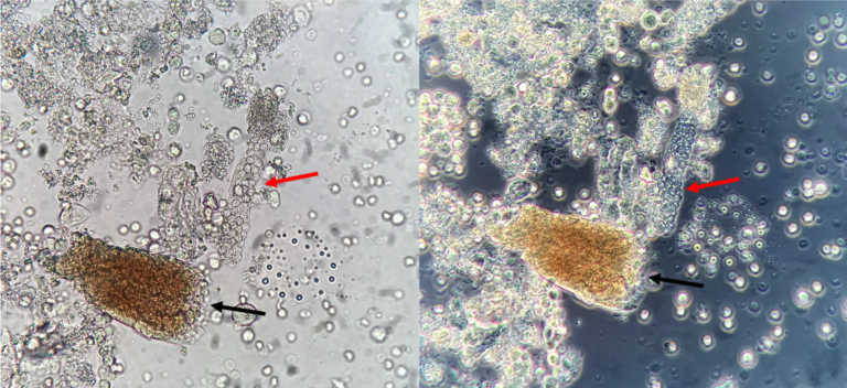 Urine Sediment of the Month: Pigmented Casts & What Those Pretty Colors ...